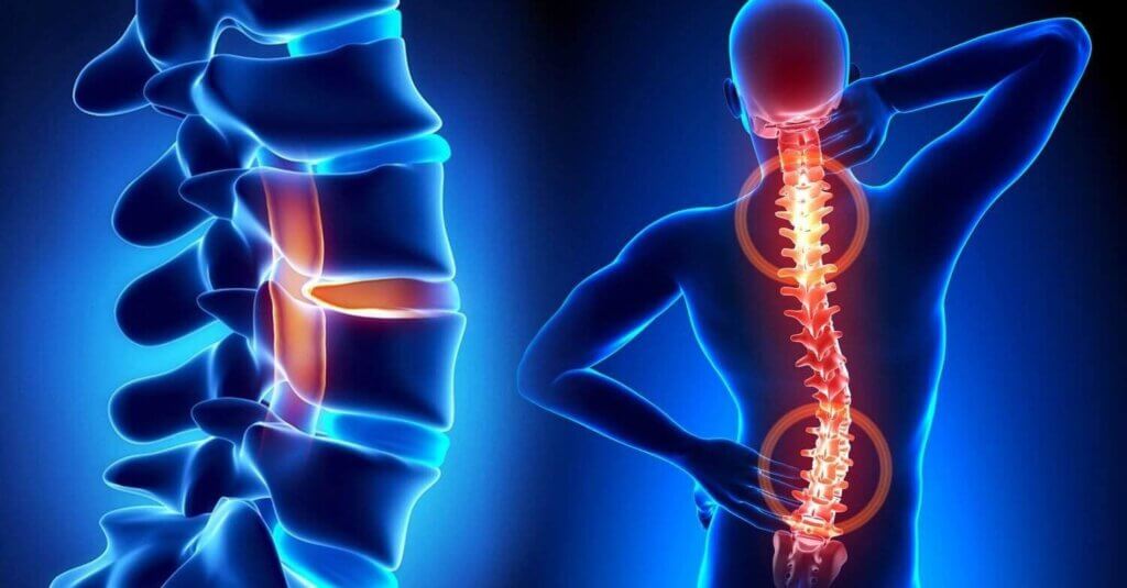 Vertebral Disc Injuries - Madrid Health | Chiropractor in Madrid