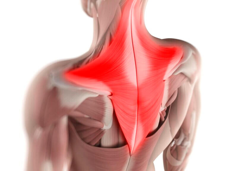 Dolor de trapecio: entender y aliviar el dolor de cuello - Madrid ...